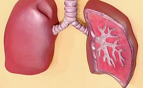 Bronchiectasis: a dangerous complication of bronchitis