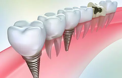 Döwrebap tehnologiýa: diş implantlary