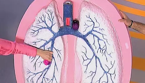 Sarcoidosis: unha misteriosa enfermidade pulmonar