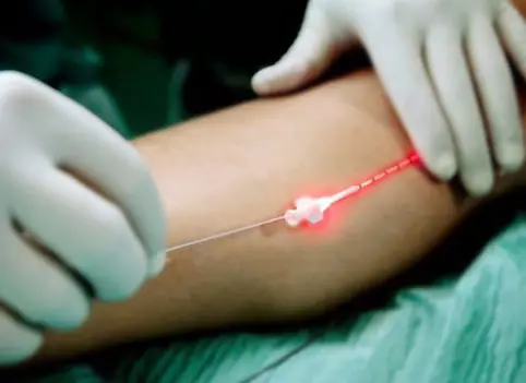 Ang mga teknolohiya sa laser sa pagtambal sa mga varicose veins