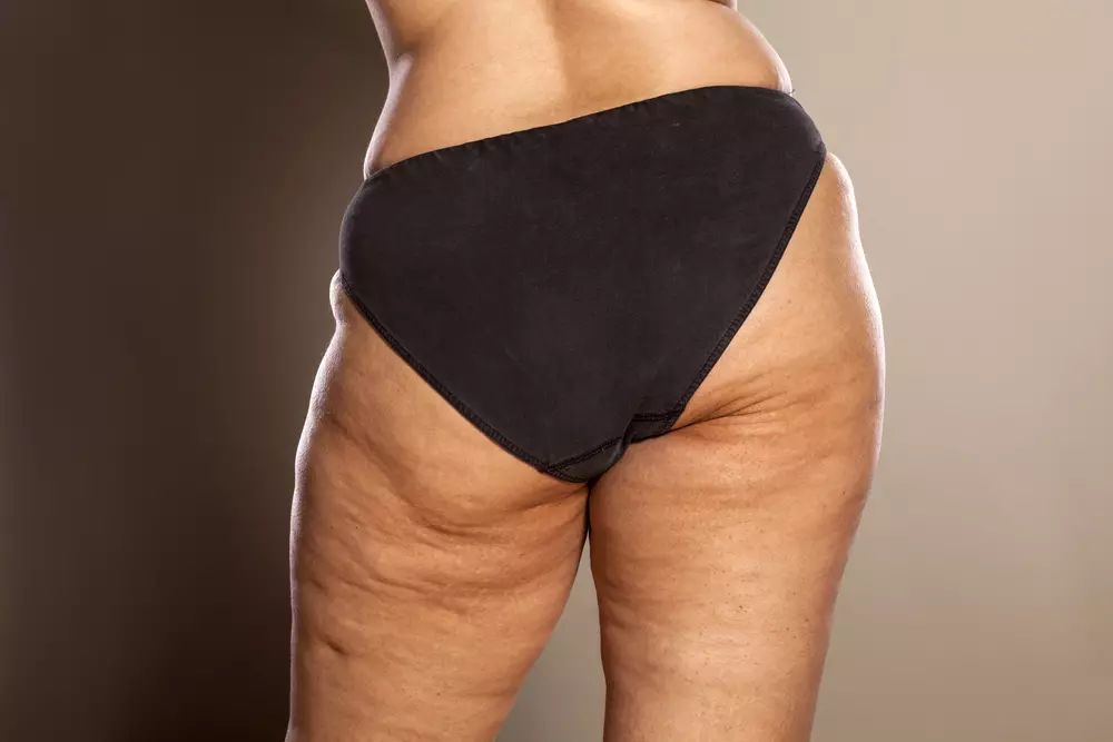 Cellulite Alle wierheid en myten