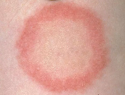 Kuzindikira komanso kupewa kwa dermatomycosis