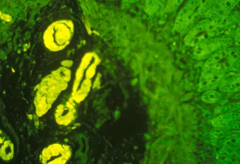 Amyloidosis adalah penyakit yang jarang berlaku 11377_1