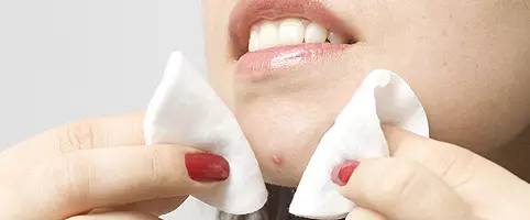 Uburyo bwo kuvura acne