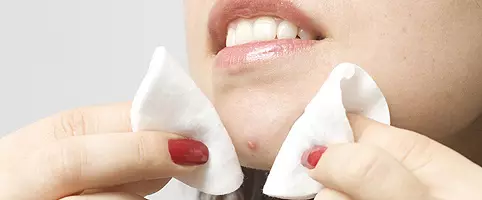 Come curare l'acne 11582_1