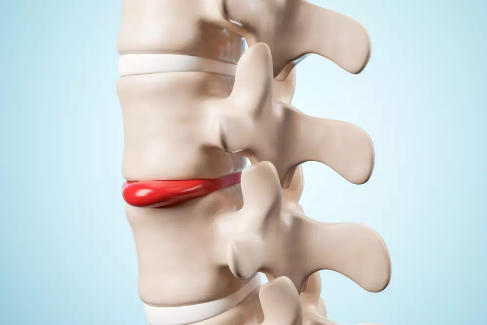 Hernia coloanei vertebrale: se poate salva fătul? 11617_2