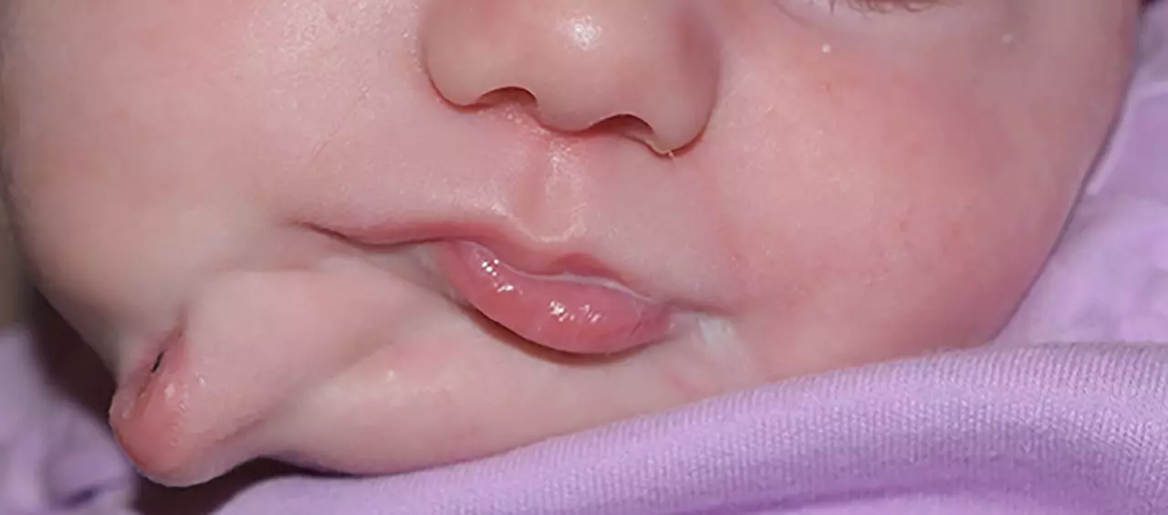 罕见异常：美国出生的婴儿有两张嘴 11745_1