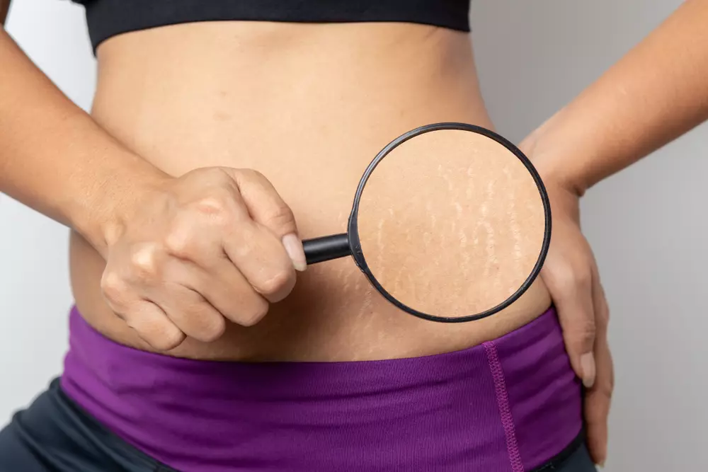 How to get rid of stretch marks 12123_1