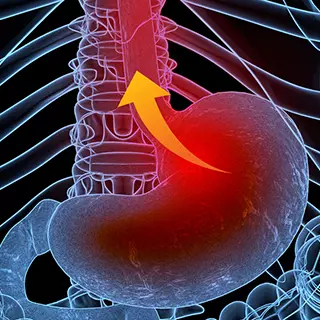 Types de troubles du tractus gastro-intestinal et leurs causes 12548_4