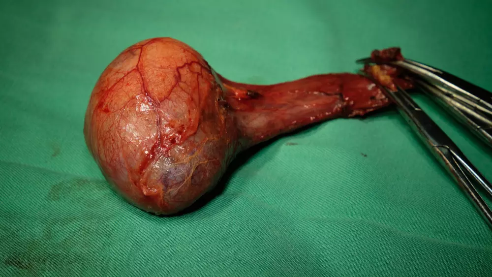 Teratoma: răng, lông và chân ở đâu trong buồng trứng 12634_3