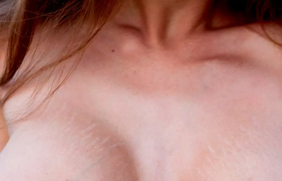 Stretch marks on the chest turned out to be a symptom of cancer