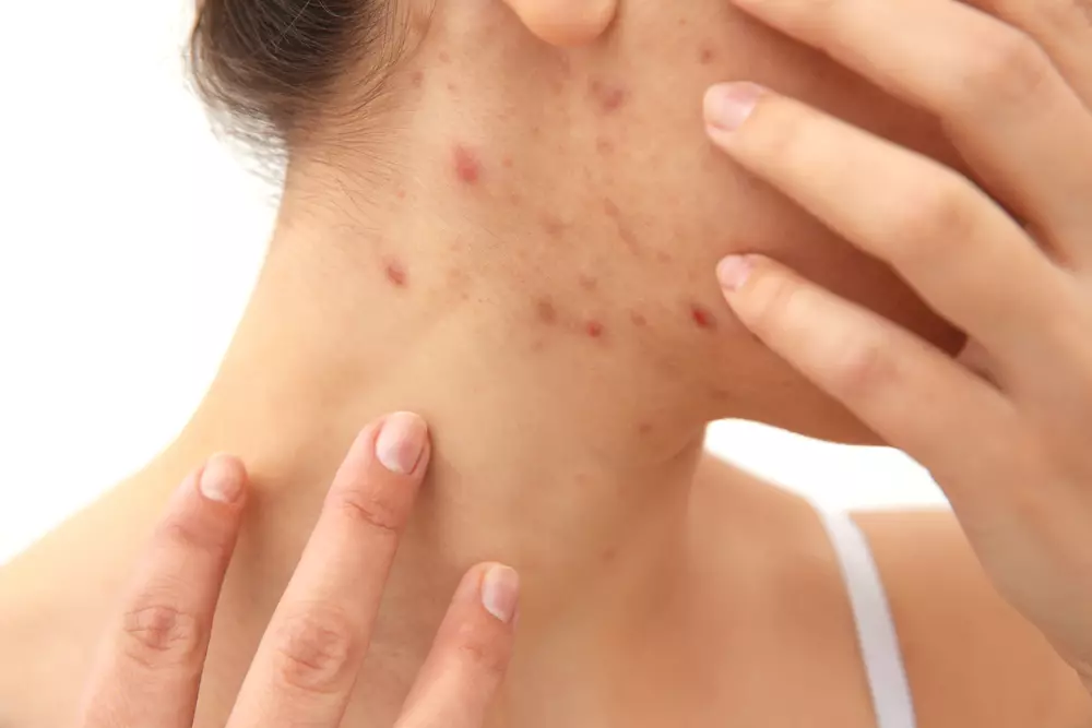 Per què tinc acne? 5 hàbits mortals per a la pell 1533_3