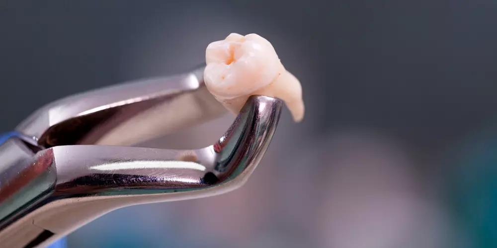 Ar būtina pašalinti išminties dantis? 5 mitai apie „aštuonetą“ 1747_3