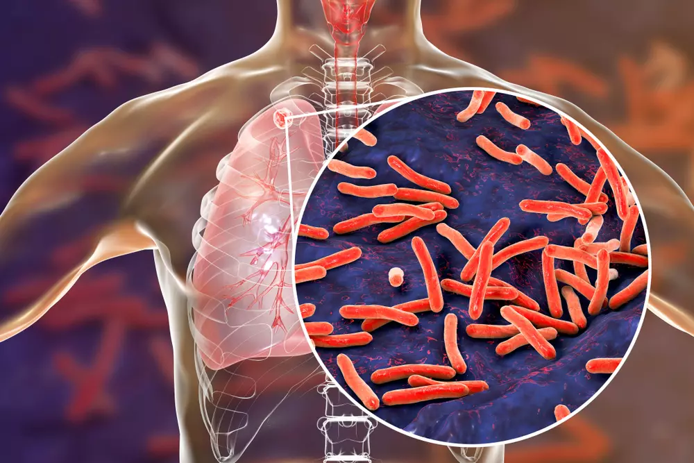 Tuberkulose: hvordan man opdager sygdommen på et tidligt stadium 1767_2