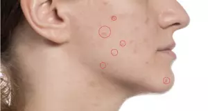 Cum se tratează corect acneea