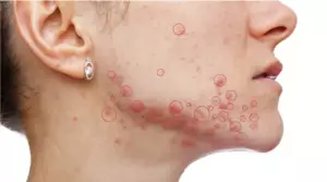 Sådan behandles acne korrekt 2766_3