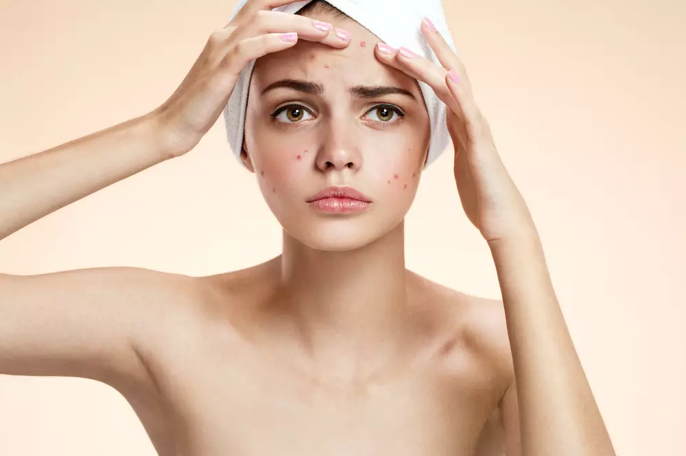 Pourquoi l'acné s'aggrave en hiver et que faire à ce sujet