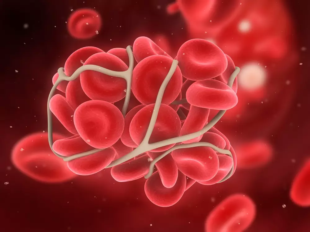 血友病患者可能形成血栓嗎？