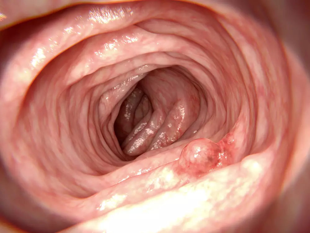 Intestinal mucosa - ang panguna nga linya sa pagdepensa sa kahimsog sa tiyan 377_3