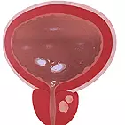 Cov roj (cholesterol) tsawg tiv thaiv cov prostate 3824_1