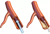 Cov roj (cholesterol) tsawg tiv thaiv cov prostate 3824_3