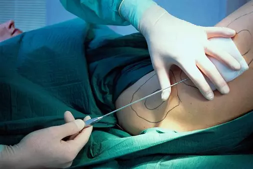 liposuction جا فائدا ۽ نقصان