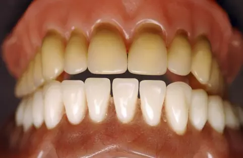 치아의 변색