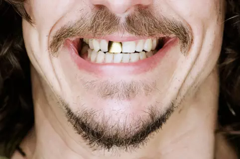Amenaza en forma de cuña para los dientes