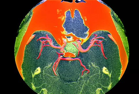 Prolactinoma: symptomen en oarsaken