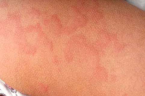 Bawo ni lati ṣe itọju awọn hives