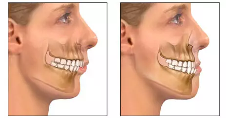 Bite: ceisteanna agus freagraí 4761_2