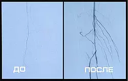 Pengobatan gangren tanpa amputasi 4792_4