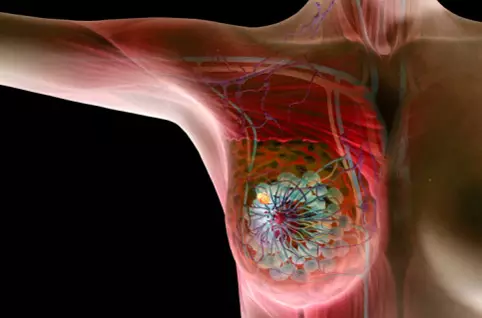 Breast cancer treatment