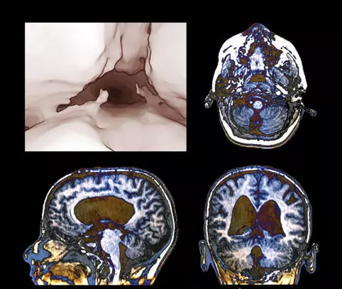 Gịnị bụ hydrocephalus 5264_1