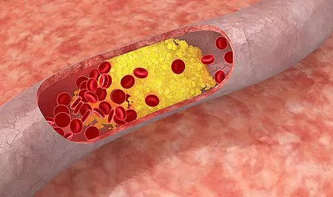 Colesterol de duas faces: como um amigo se torna um inimigo