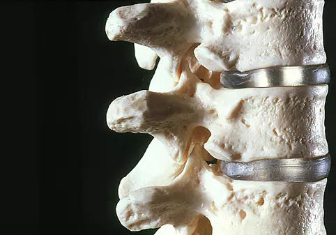 Ukuchongwa kwesifo sediserative degenerative