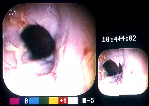 Izibonakalisa kanjani i-esophagitis nokuthi iyingozi kangakanani