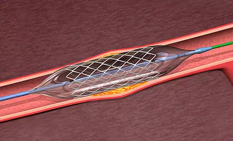 What is stenting?