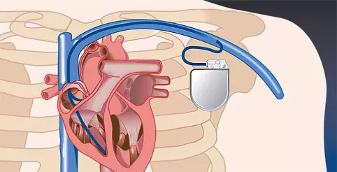 පේස්මේකර් සවි කිරීමෙන් පසු ජීවත් වන්නේ කෙසේද?