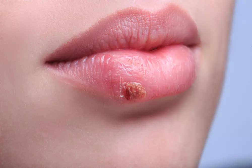 Herpes: o le a lenei faʻamaʻi