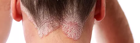 10 txoj hauv kev kom zam dhau psoriasis