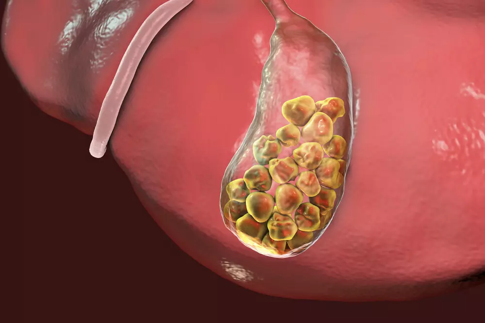 Mga epekto ng trans fats sa paglitaw ng mga gallstones 6647_3