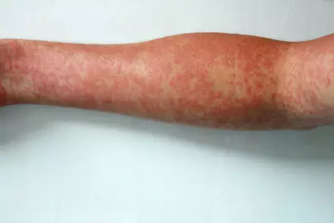 Vasculitis ឬការរលាកសរសៃឈាម