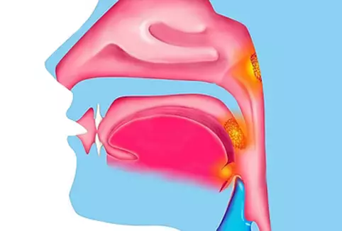 Hypertrophie des végétations adénoïdes