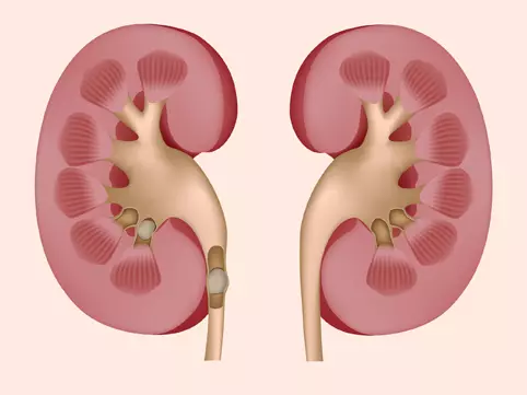 Urolithiasis بيماري 7574_1