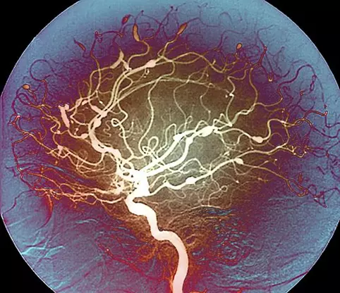 Serebral anevrizma