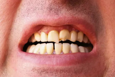 Dente scheggiato o saltato