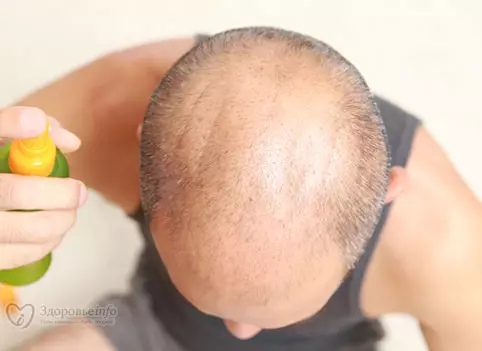 Masalah Rambut Rontok Terpecahkan! Dokter membuat kepala botak menjadi tertutup rambut!