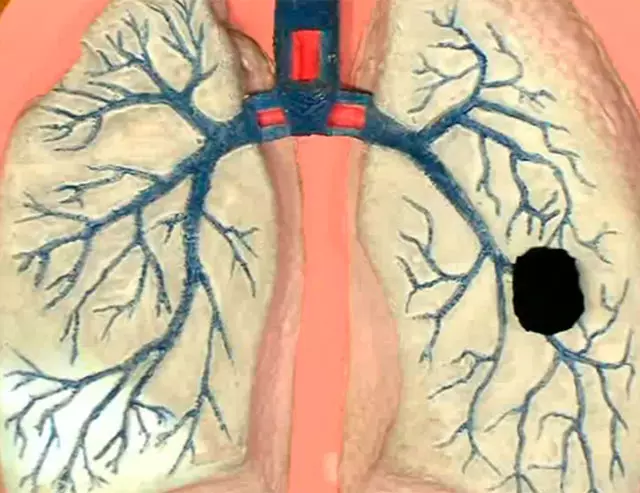 Pwogram nan "Viv an sante" soti nan 02/04/2015: Twa tès pou gason ki gen tete fi. Gynecomastia kòm yon sentòm - videyo