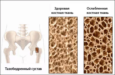 Остеопороздан қалай сақтануға болады 80070_2